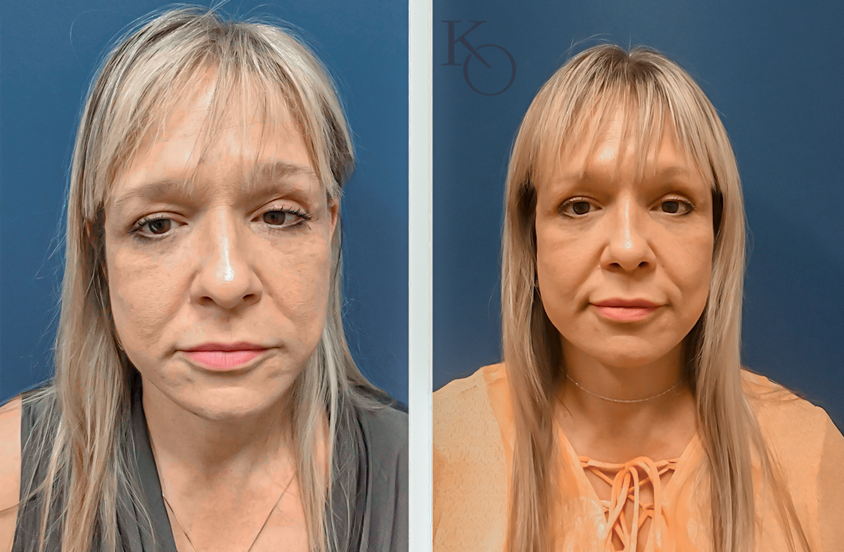 Rhinoplasty Lafayette, LA - Plastic Surgeon | Cosmetic Surgery | Dr ...